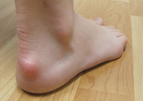 Haglund Deformity Boney Prominence Over Back Of The Heel On A 15 Year 